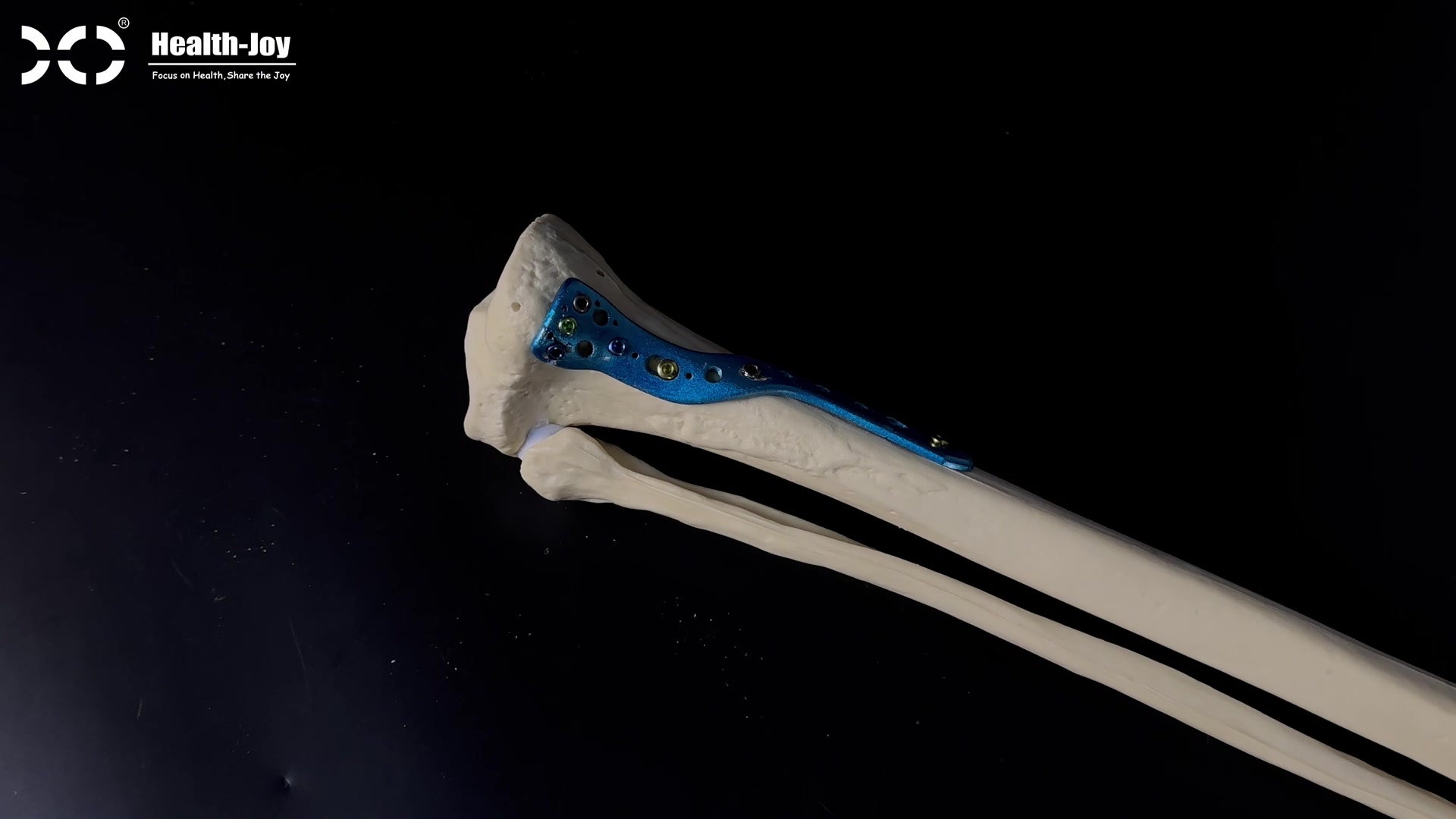 VA LCP Fixation of Proximal Tibial Both | HEALTH-JOY MEDICAL ...
