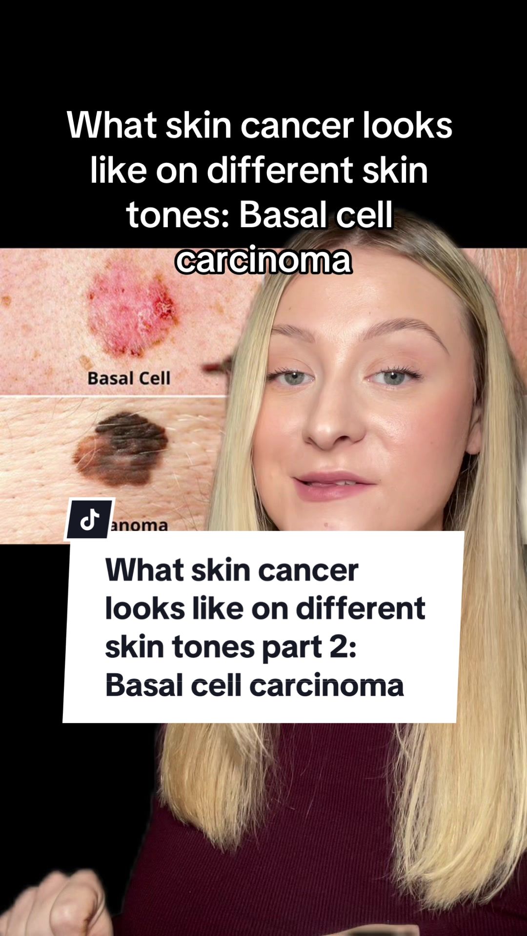 What skin cancer looks like on | Maddy | Dermal Clinician (@mads.skin)