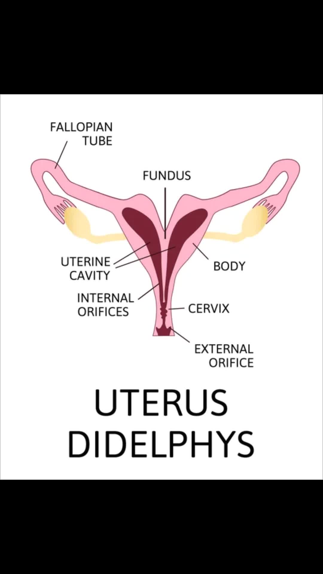 Uterus didelphys is a rare congenital | Med Stud (@medstud10)