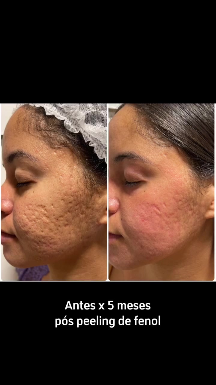 Antes e Depois. 5 meses de peeling de | Madson Sales (@drmadsonsales)