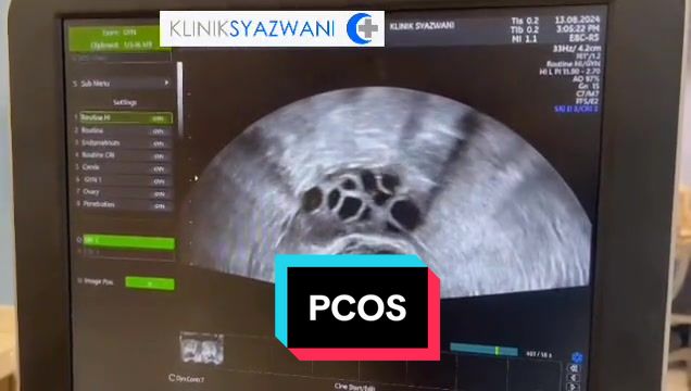 Apa Itu PCOS? PCOS (Polycystic Ovary | Klinik Medik Premier ...