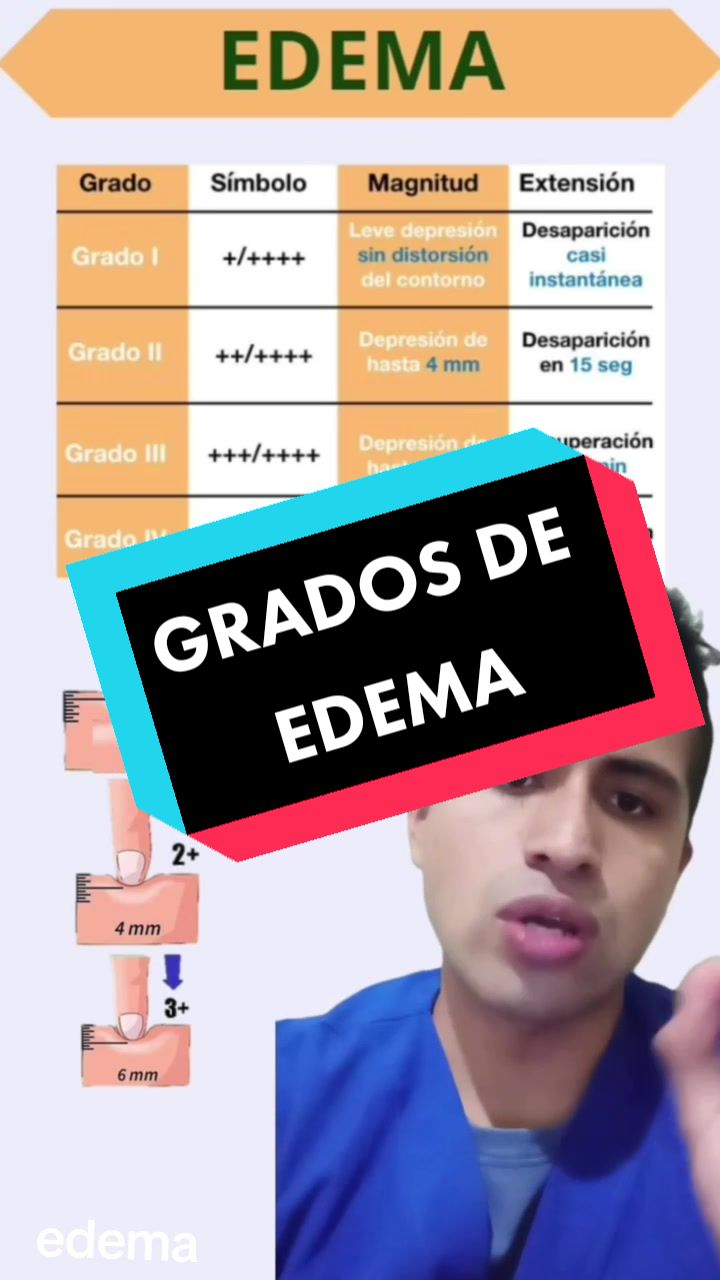 Grados de edema, edema en piernas | MediClases Fácil (@mediclasesfacil)