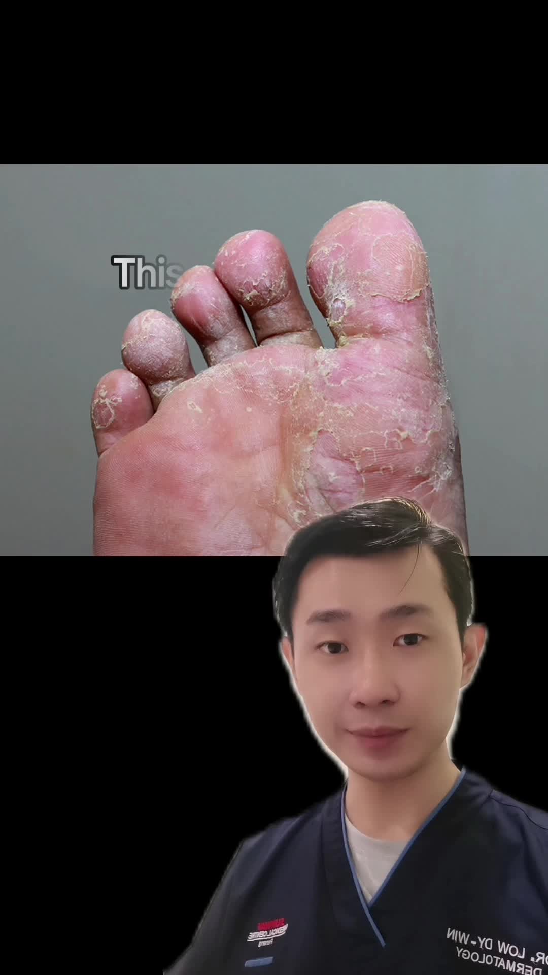 Ringworm of the body (tinea corporis) | AskDrLow Dermatologist (@askdr ...