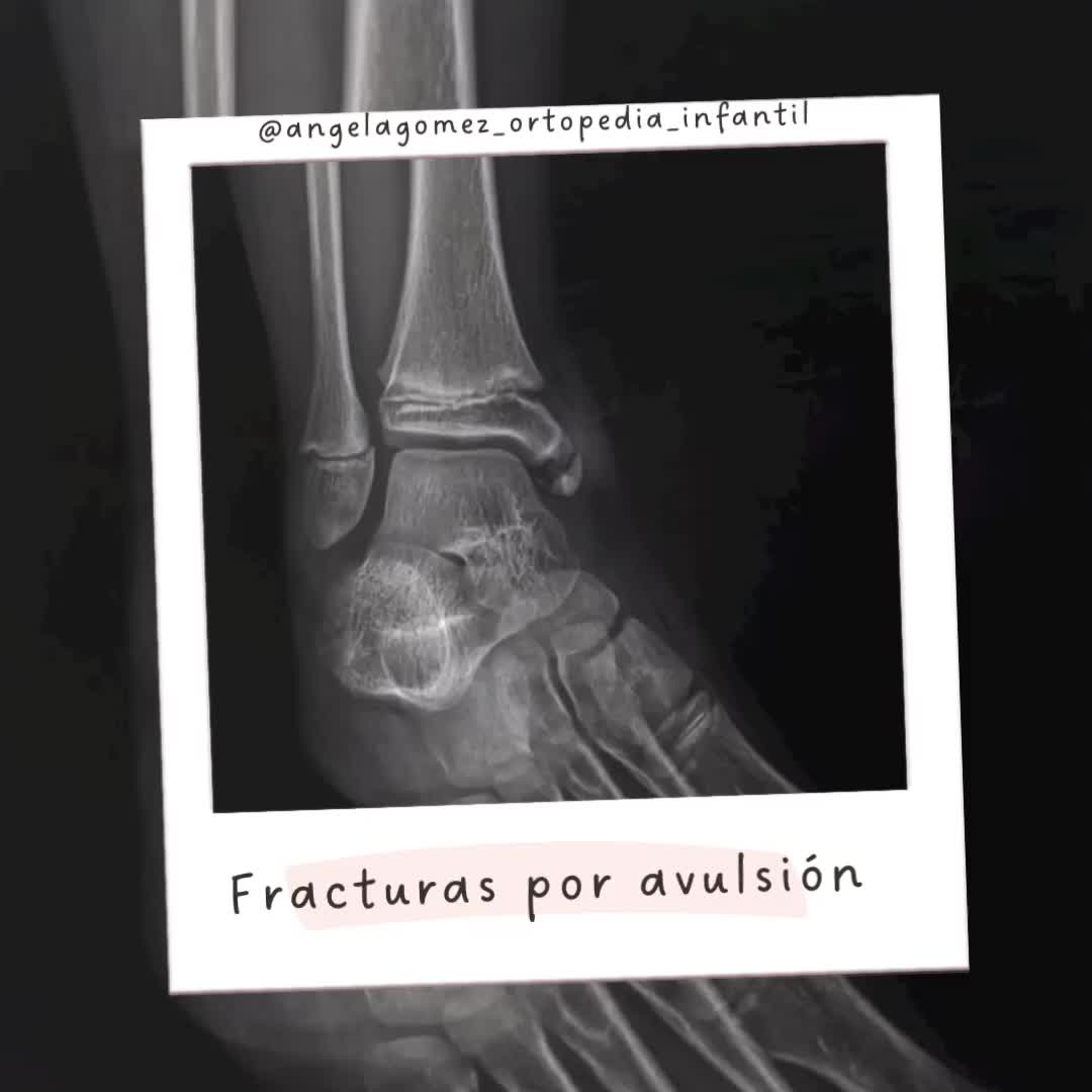 Las fracturas por avulsion, son | Dra Angela M Gomez (@draangelagomez1)
