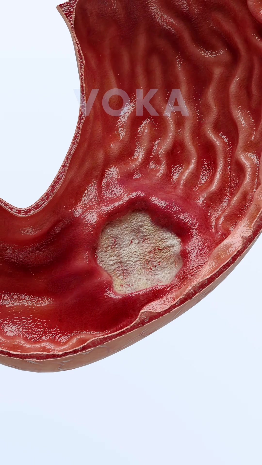 The anatomy of Gastric Ulcers: a 3D | VOKA 3D Anatomy & Pathology ...