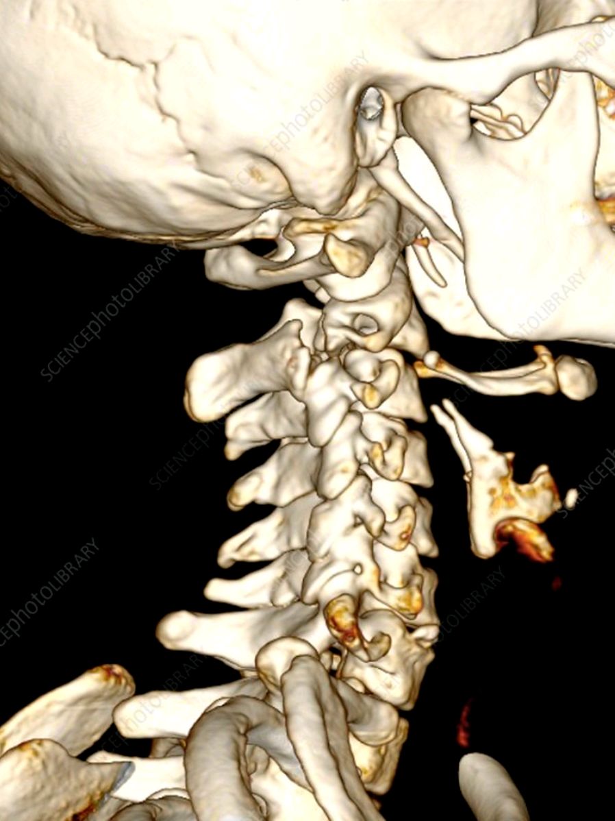 🧠 Let’s talk about cervical spinal cord | ♿️BriannaSeewald♿️ ...