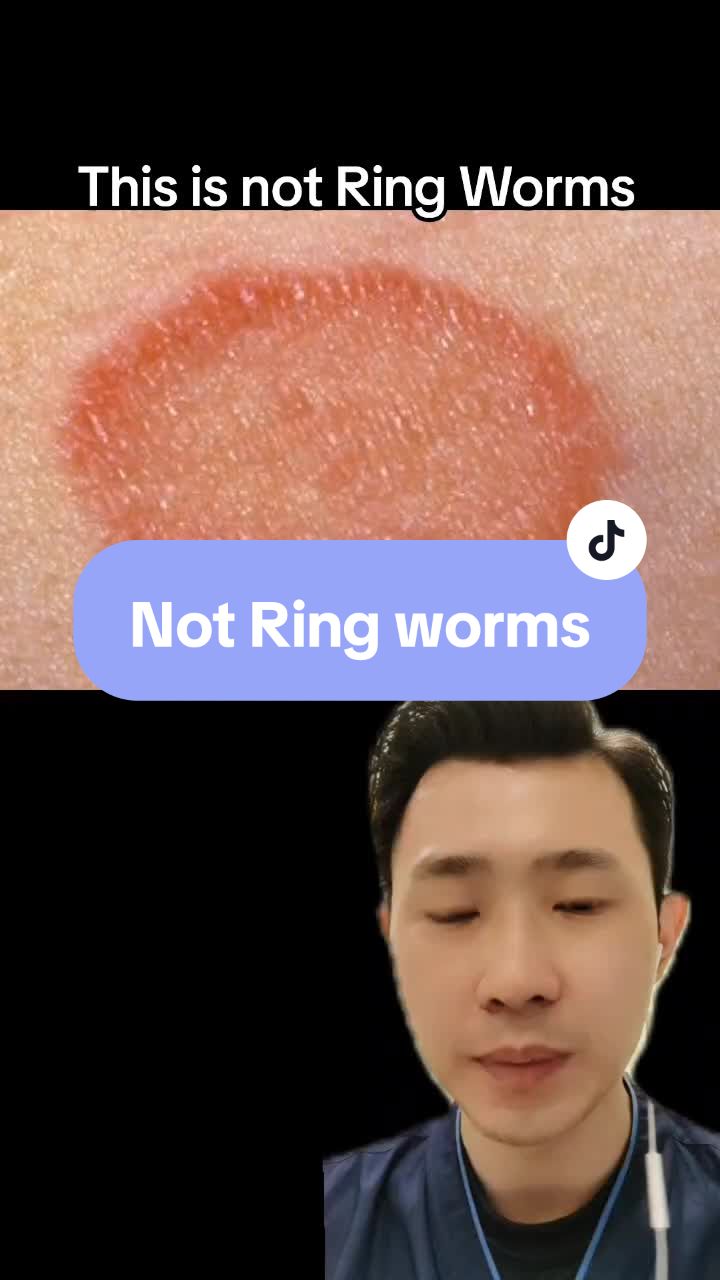 Pityriasis rosea is | AskDrLow Dermatologist (@askdr.low.dywin)