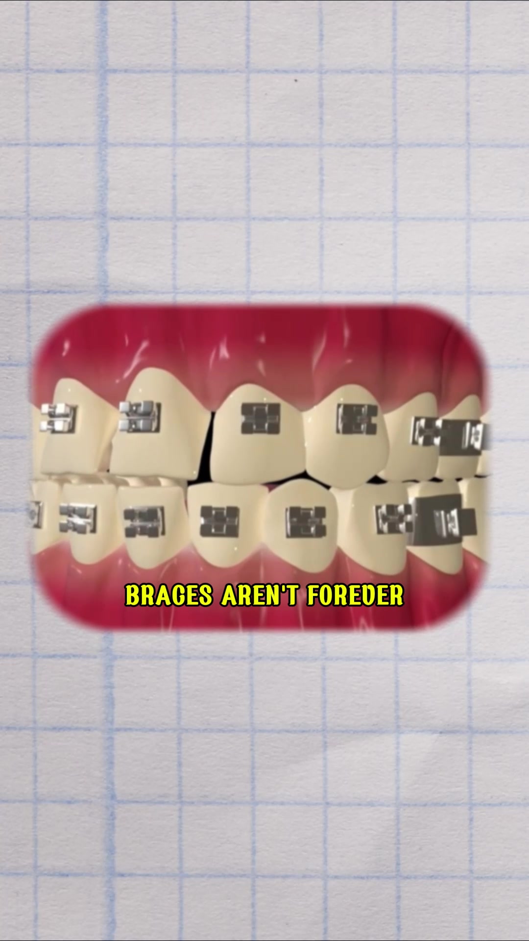 Braces Timeline: What to Expect Month | Unique Orthodontics ...