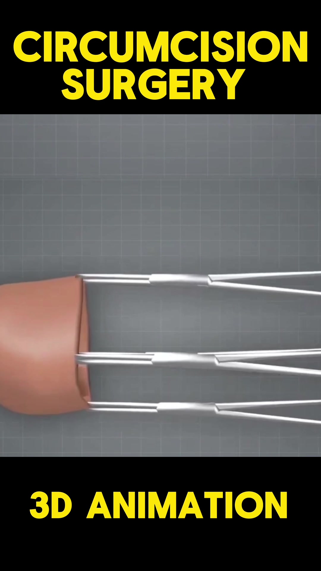 Circumcision surgery medical animation | medicalinf0 (@medicalinf0)
