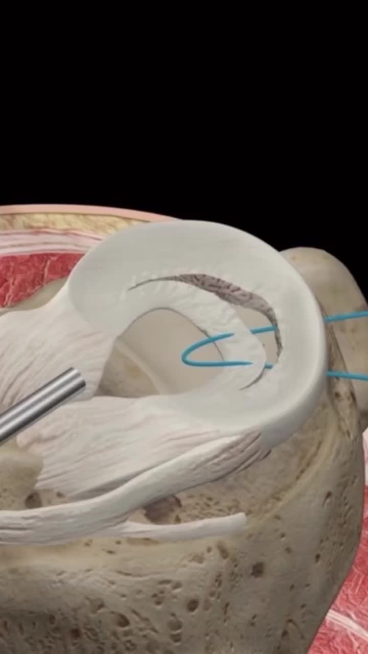 proses operasi lutut (meniscus repair) | Monsphysio (@monsphysio)