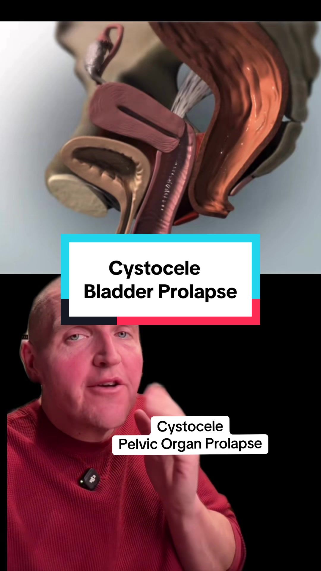 Cystocele is a type of pelvic organ | Josh Cottle (@scibodytherapy)