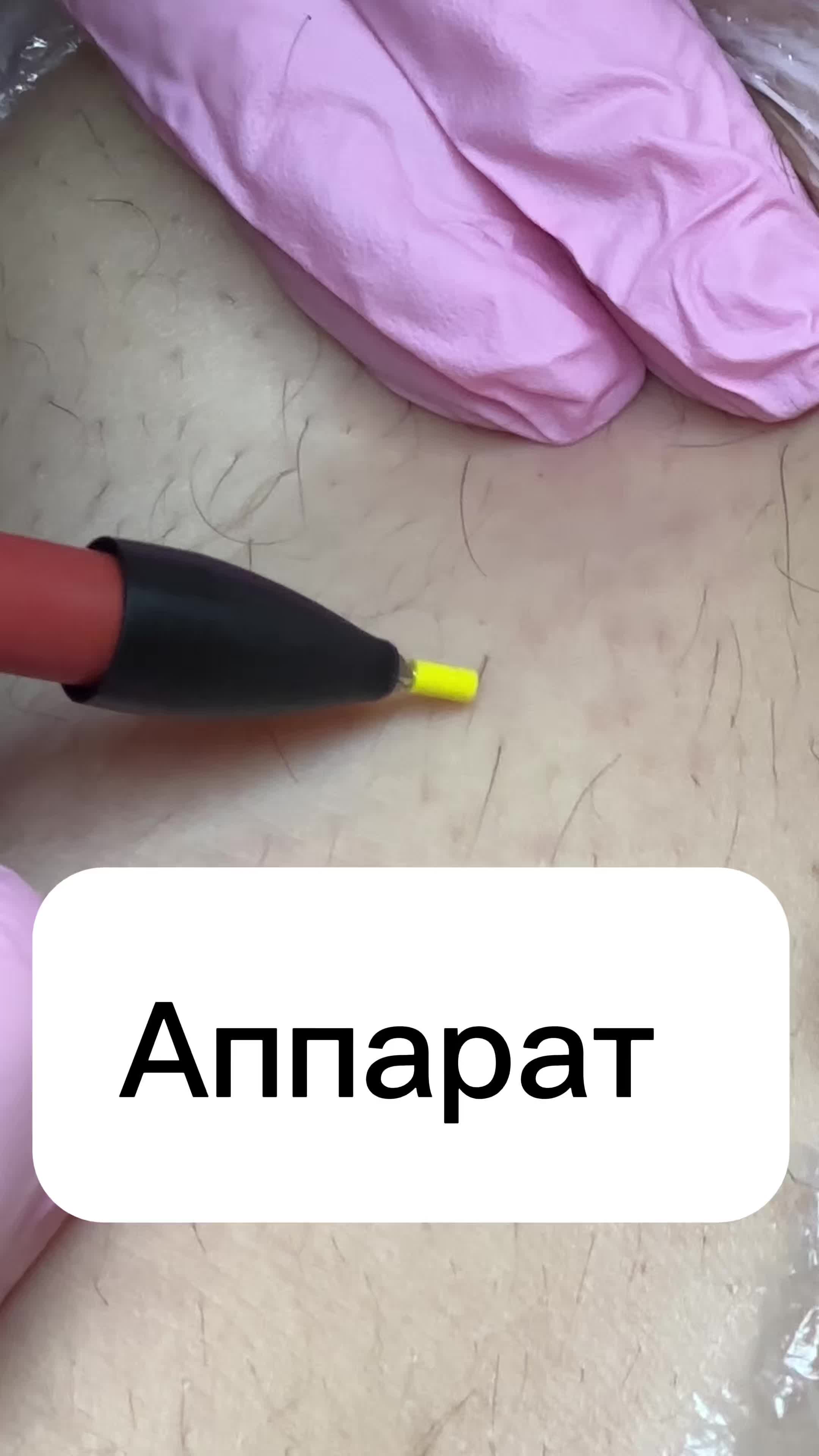 Аппарат #электроэпиляция | Герониме электроэпиляция (@geronime.epil)