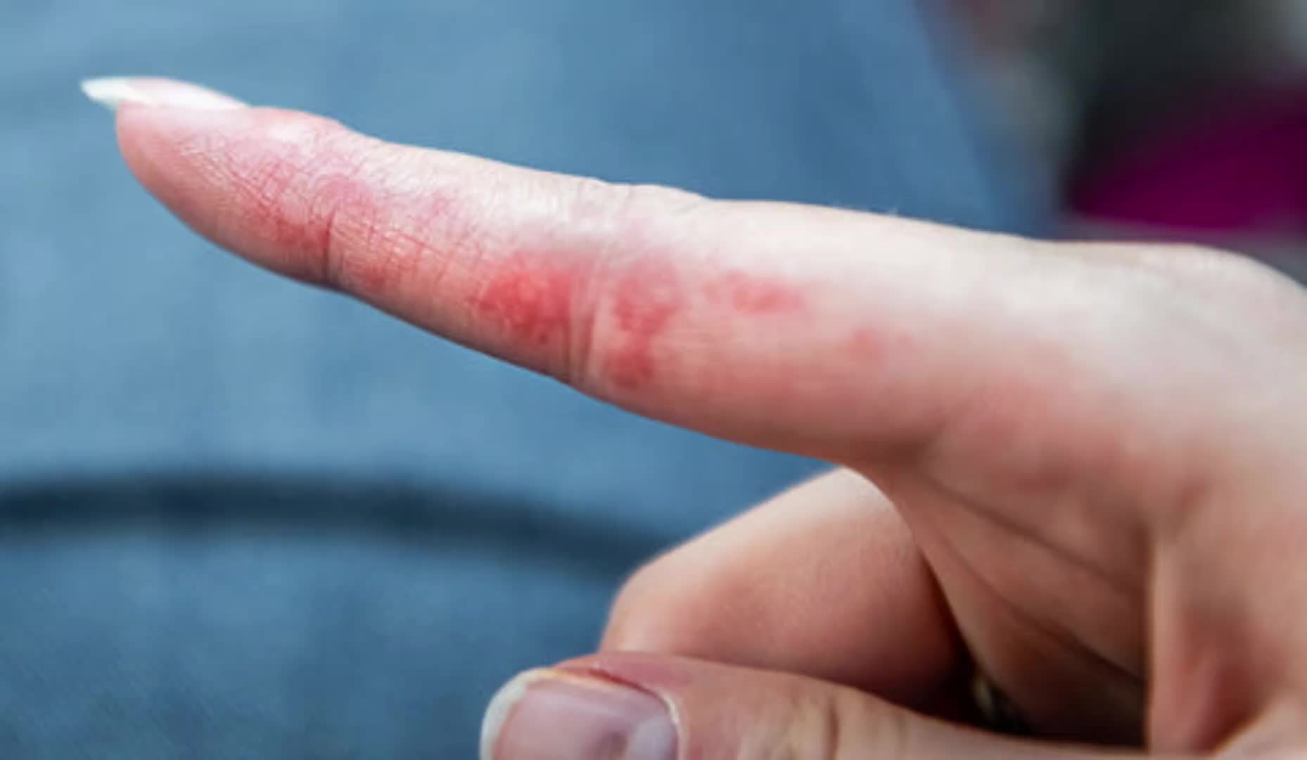 #CapCut Dyshidrotic eczema, also known | HealthDaily (@healthdaily1)