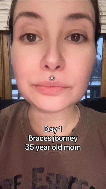 Mallaclusion II, overjet, and | MamaMushroom (@_mamamushroom_)