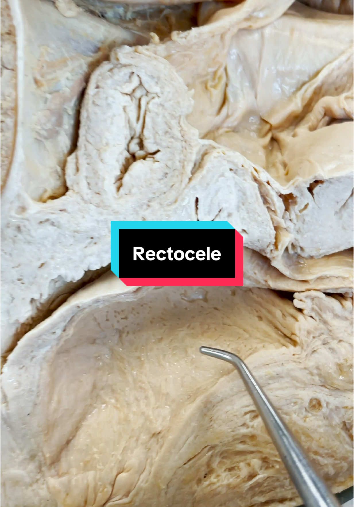 #rectocele - TikTok Hashtag