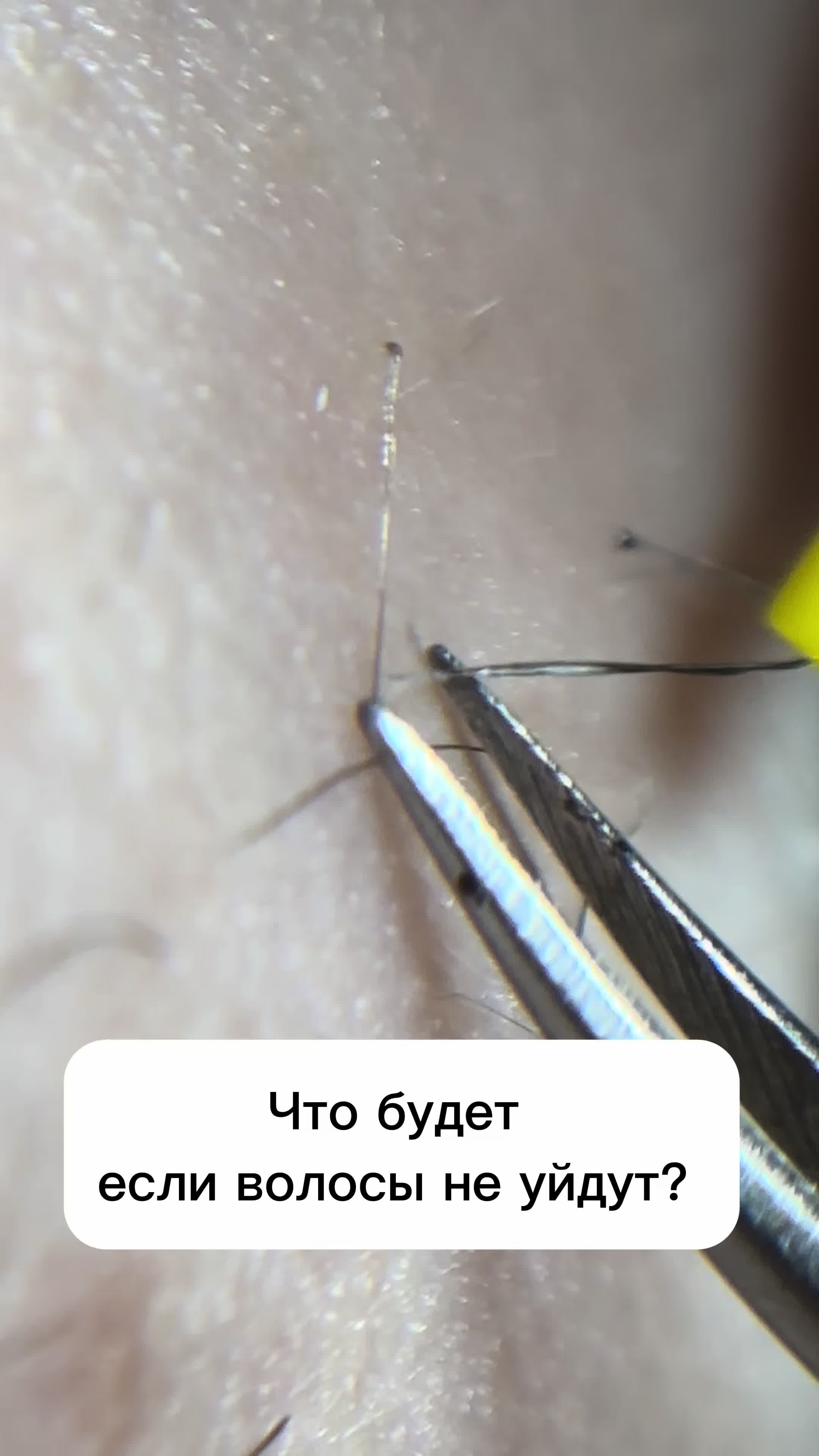 Что будет если волосы не уйдут | Герониме электроэпиляция (@geronime.epil)