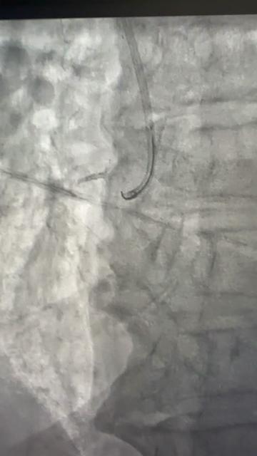 Cath Lab Nightmare: Rare Ostial RCA | Heart & Vascular Medical Ctr ...