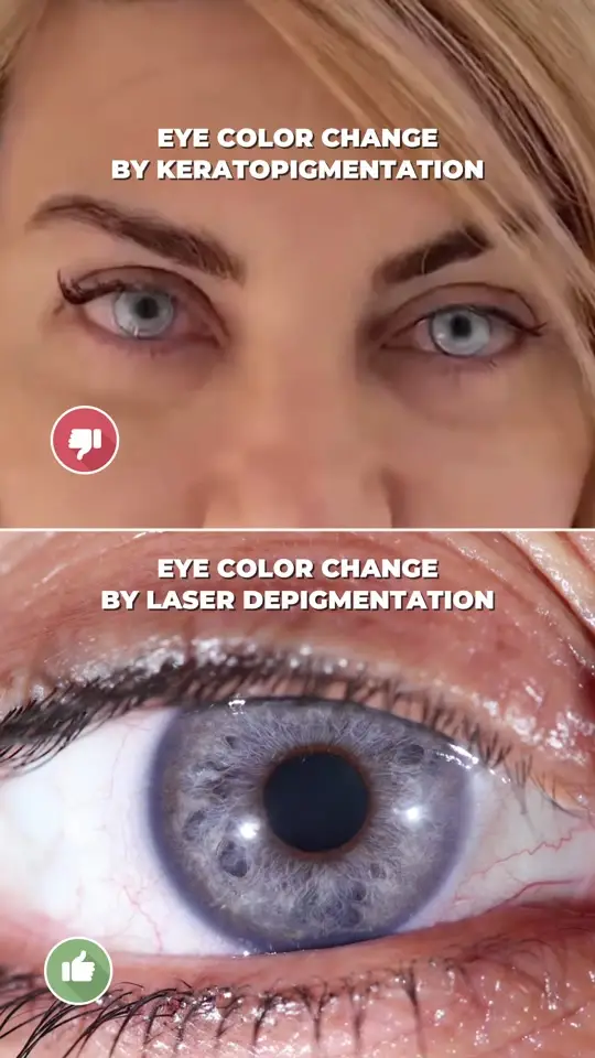 ⚠️ Not all eye color change techniques | Eyecos Clinic (@eyecosclinic)