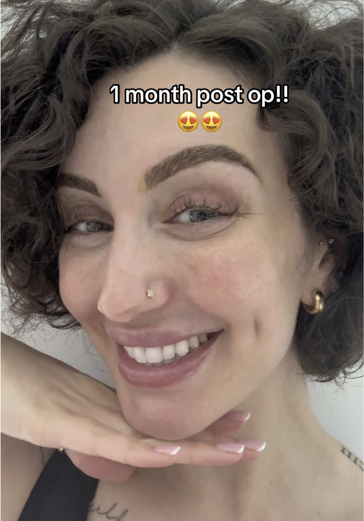 One month ago i had cosmetic surgery | franncchii (@franncchii)