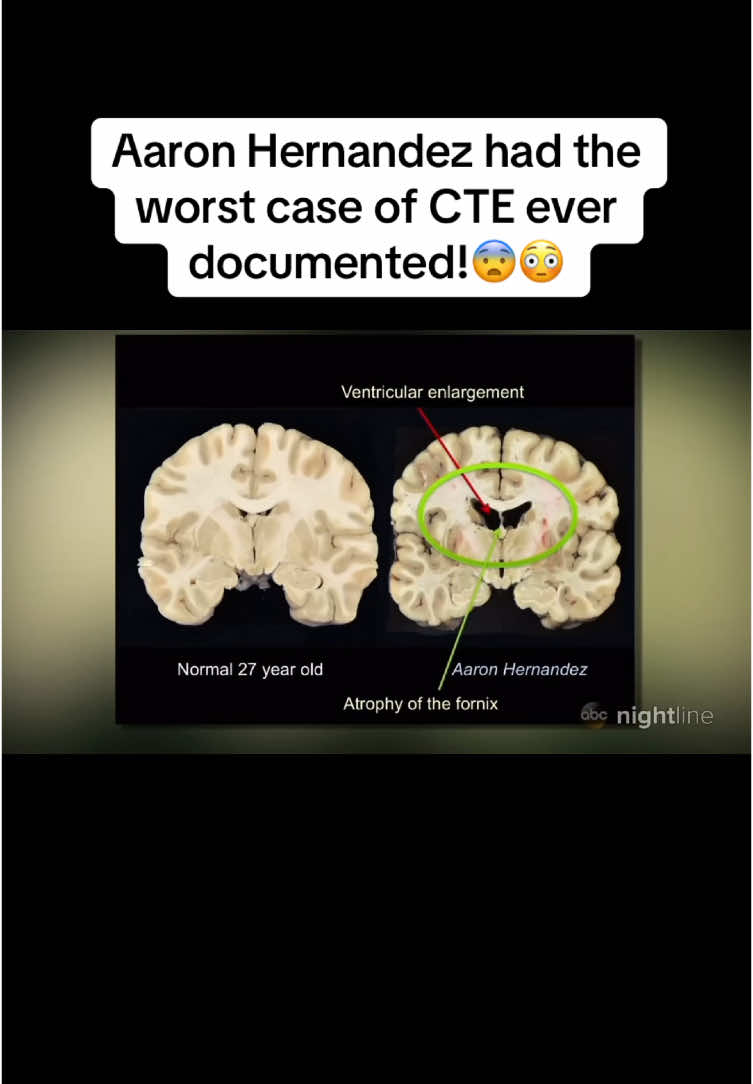 Aaron Hernandez CTE / brain damage was | Aaron Hernandez Legacy🕊️ (@81aaron.hernandez)